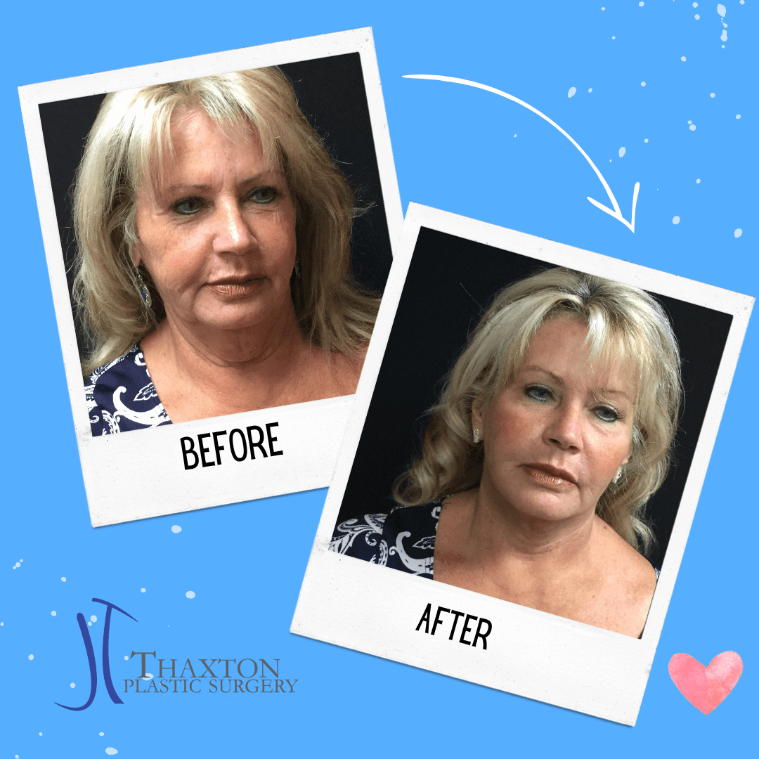 Face lift vs Filler | Story of a Pretty Face - Thaxton Plastic Surgery